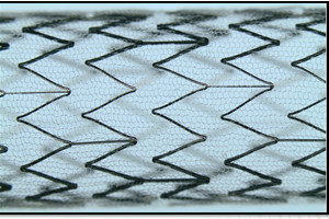 CGuardians II shows positive 30-day outcomes for carotid stent use in ...