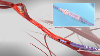 Silk Road Medical receive CE mark for next-generation Enroute ...