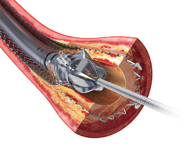 Jetstream atherectomy system granted new CE mark for in-stent ...