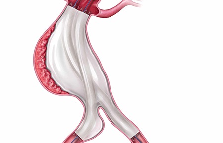 Endologix recieves IDE approval for EVAS2 Nellix trial - Vascular News