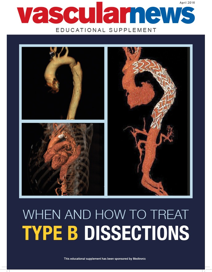 When and how to treat type B dissections - Vascular News
