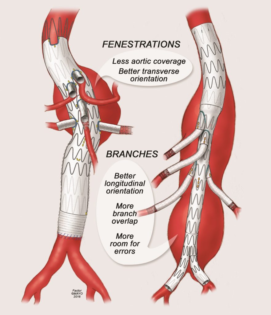 Early follow-up of FEVAR/BEVAR using supra-coeliac sealing zones and ...