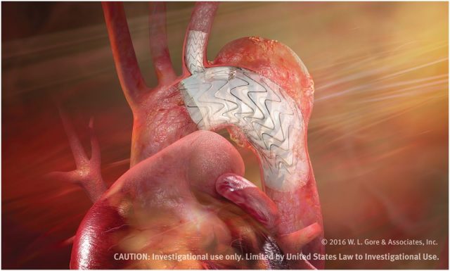 First implant completed in pivotal study of Gore TAG thoracic branch ...