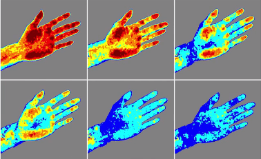 Achieving haemostasis in radial artery access - Vascular News