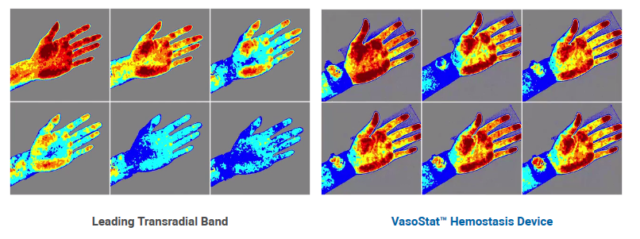 Achieving haemostasis in radial artery access - Vascular News