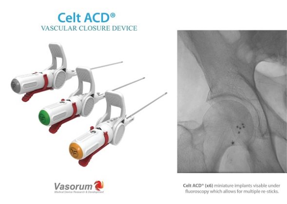 Vasorum launches Celt ACD second generation vascular closure device in ...