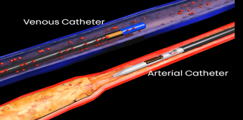 LimFlow completes enrolment in US feasibility study - Vascular News