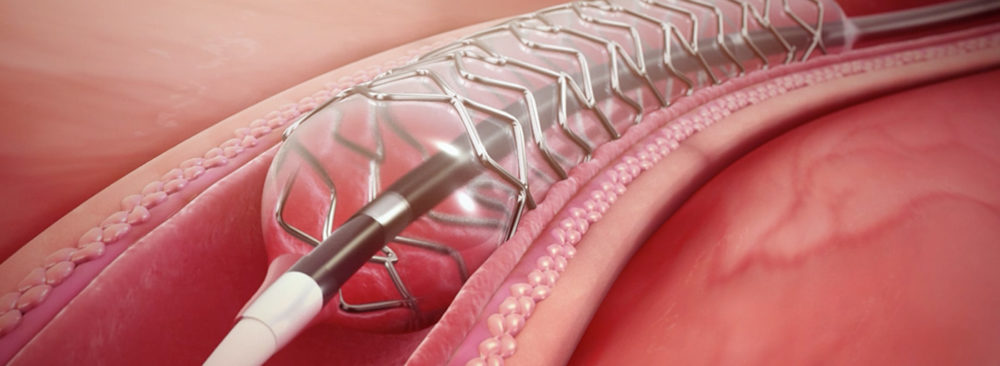 Deployable coating stents delivers drug more uniformly than traditional ...
