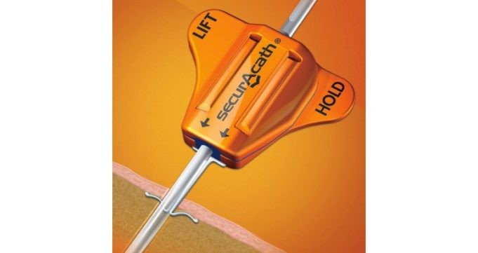 NHS to fast-track SecurAcath device use - Vascular News