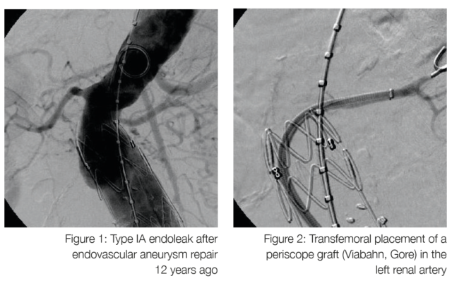 Chimney EVAR rising: Will the technique overcome perceived shortcomings ...