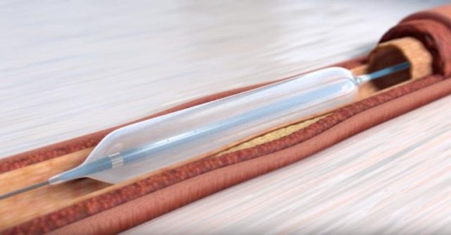 Virtue sirolimus-eluting balloon set for commercial release as Terumo ...