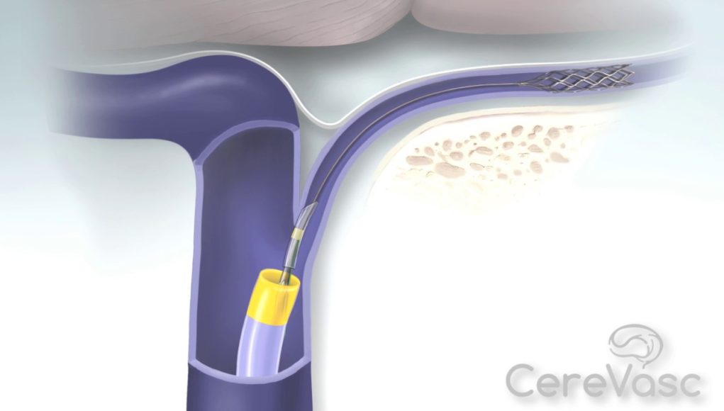 CereVasc receives approval to initiate first-in-human clinical study of ...