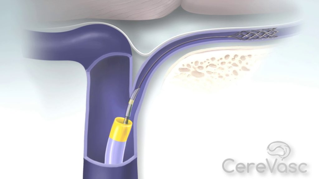 CereVasc receives approval to initiate first-in-human clinical study of ...