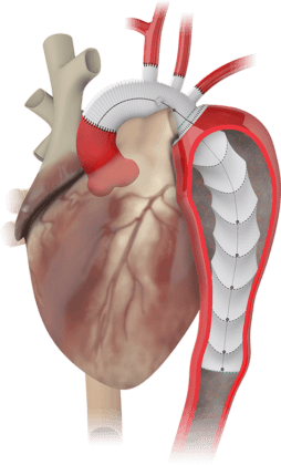 Terumo Aortic announces US FDA breakthrough device designation for ...