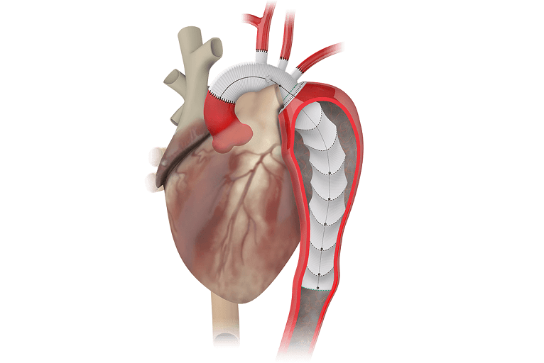 Terumo Aortic announces US FDA breakthrough device designation for ...