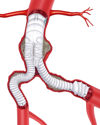 Third-generation Anaconda endograft indicates “satisfactory” aneurysm ...