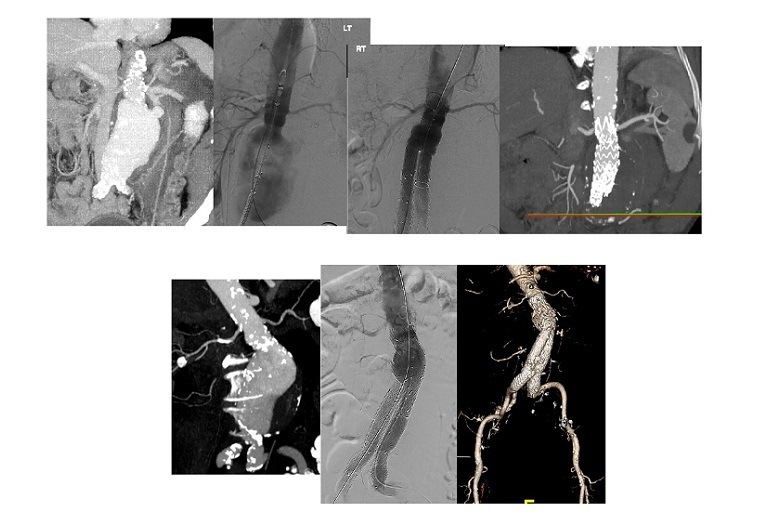 Are EVAR complications lower than they were a decade ago?