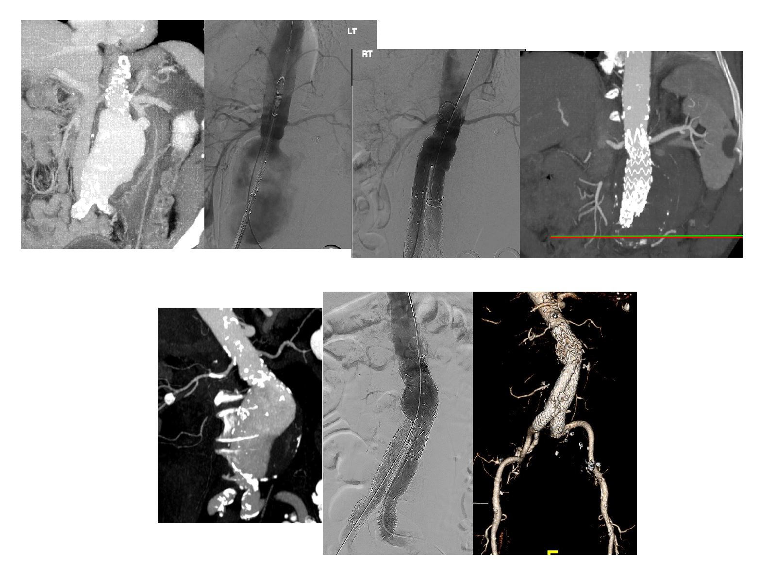 Are EVAR complications lower than they were a decade ago?
