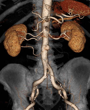 “The right tool”: Balloon-expandable covered stent matches treatment to ...