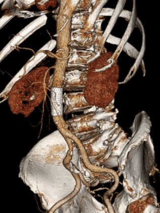 “The right tool”: Balloon-expandable covered stent matches treatment to ...