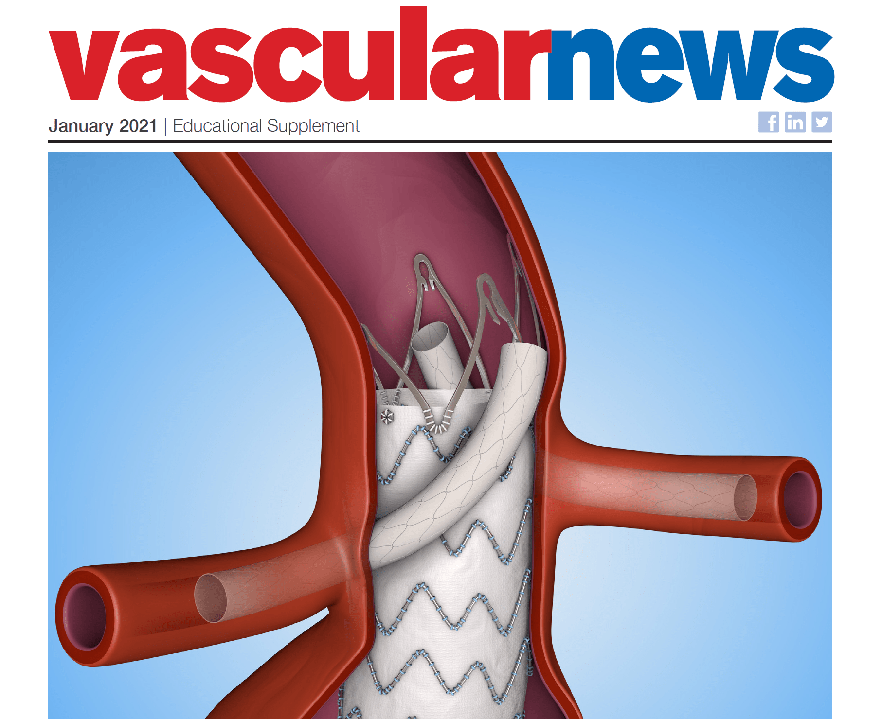 ChEVAR technique essentials: A practical guide to chimney endovascular ...