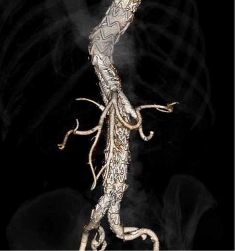High-volume experience and multicentre data show suitability of BeGraft ...