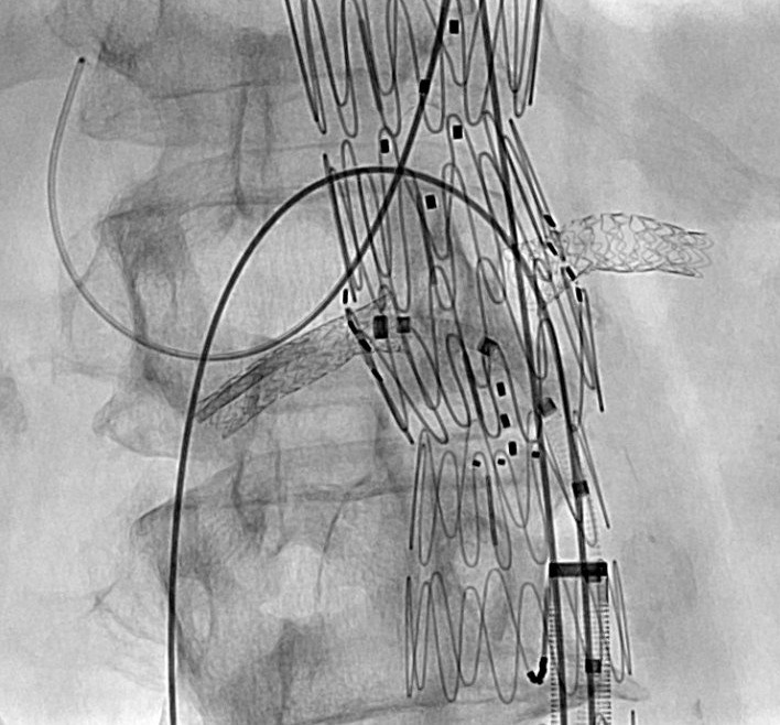 Studies pursue on-label bridging stent use in complex aortic procedures