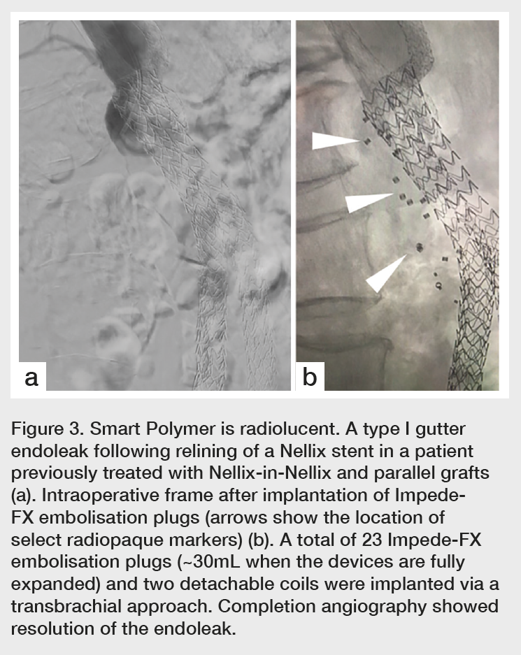 A vascular surgeon’s perspective on the benefits of shape memory ...
