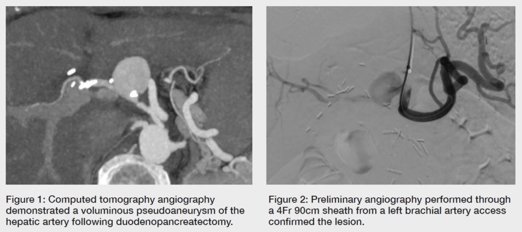 Bentley provides complete vascular solution with comprehensive covered ...