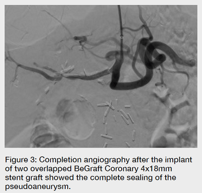 Bentley provides complete vascular solution with comprehensive covered ...