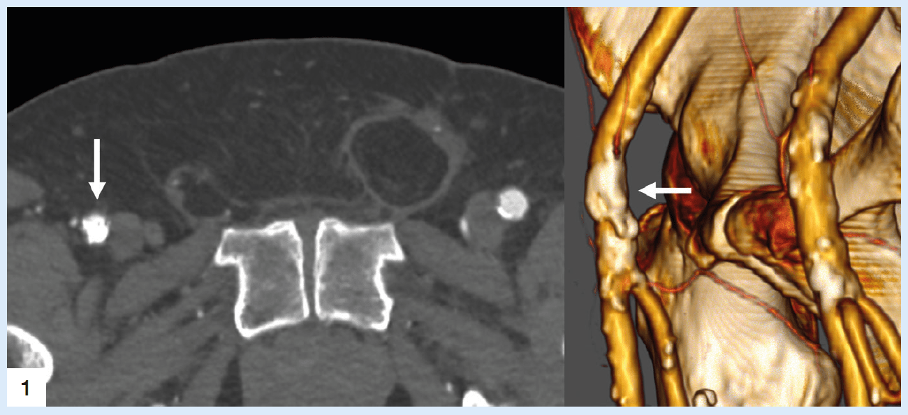 Shockwave IVL: A paradigm shift in the treatment of CFA lesions