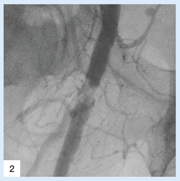 Shockwave IVL: A paradigm shift in the treatment of CFA lesions