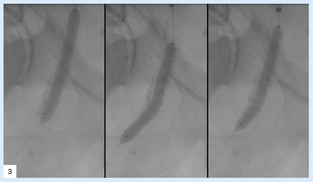 Shockwave IVL: A paradigm shift in the treatment of CFA lesions