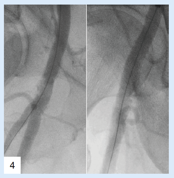 Shockwave IVL: A paradigm shift in the treatment of CFA lesions