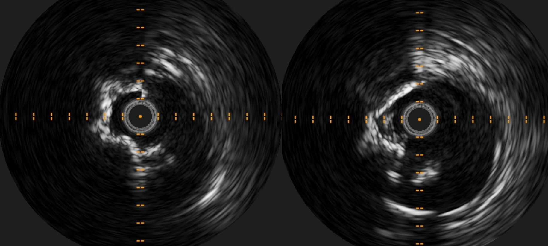 Shockwave IVL: Improving compliance is the key to “best endovascular ...