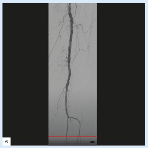 Shockwave IVL: Preserving options in no-stent zones