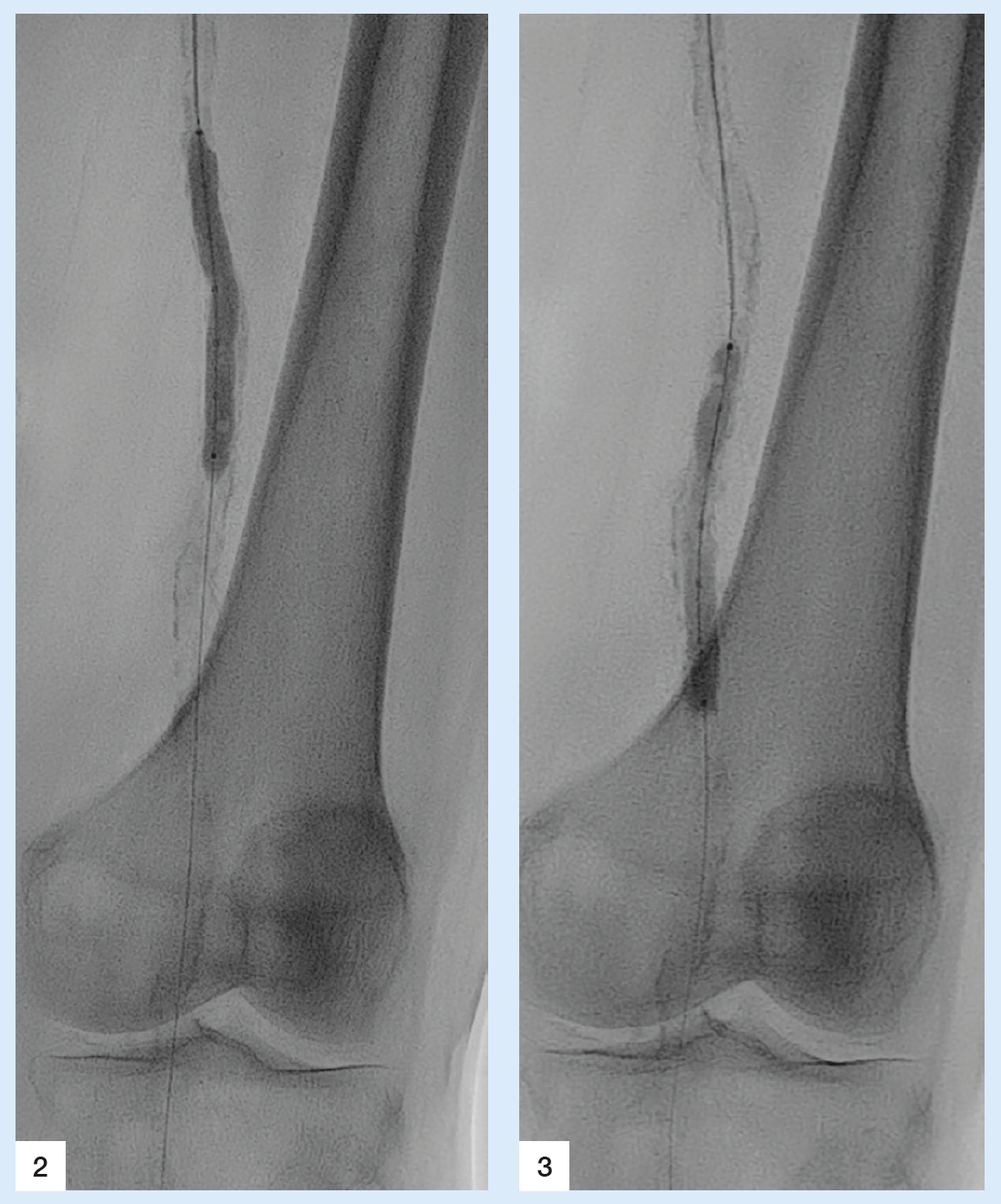 Shockwave IVL: Preserving options in no-stent zones