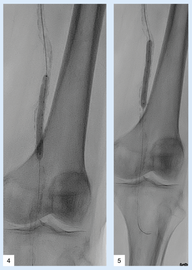 Shockwave IVL: Preserving options in no-stent zones