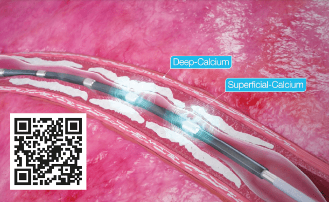 Shockwave IVL: Sound science reinforced by sound evidence