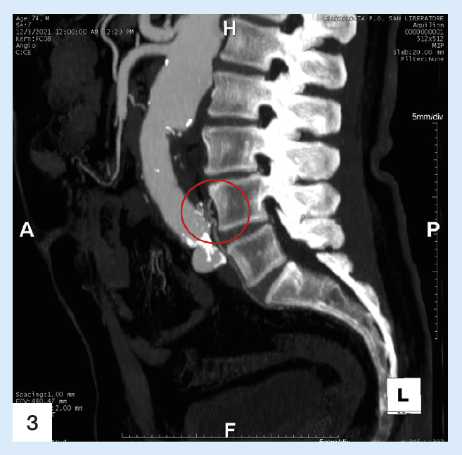 Shockwave IVL: The last piece of the puzzle to overcome the challenge ...