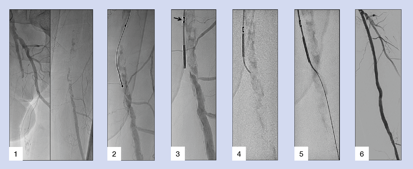 The BeBack crossing catheter: A “game-changer” in endovascular PAD practice