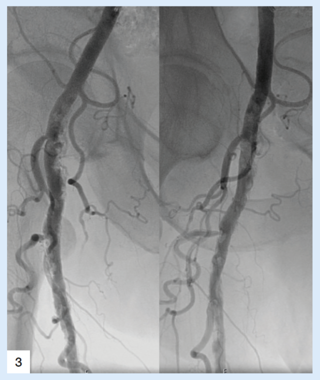 Shockwave IVL: Improving compliance is the key to “best endovascular ...