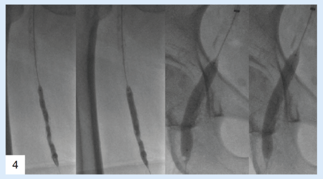Shockwave IVL: Improving compliance is the key to “best endovascular ...