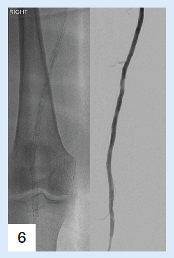 Shockwave IVL: Improving compliance is the key to “best endovascular ...