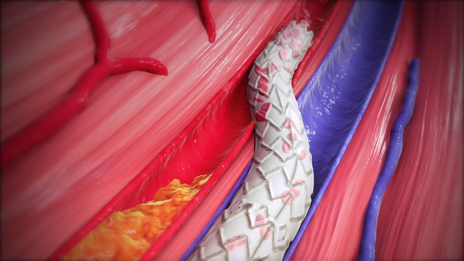 US FDA approves LimFlow system for treatment of CLTI - Vascular News