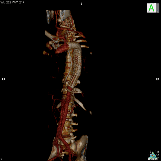 Aortic device conformability: Adapting to the anatomy for better ...