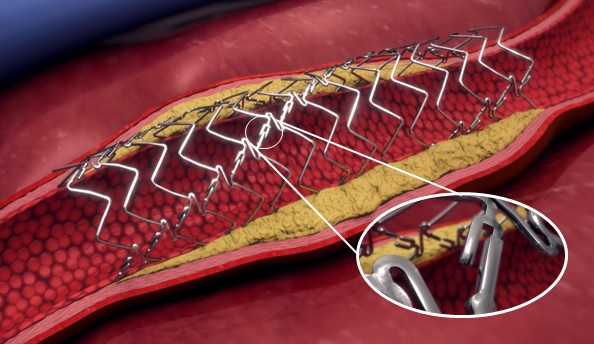 FDA Breakthrough Device designation granted for DynamX BTK