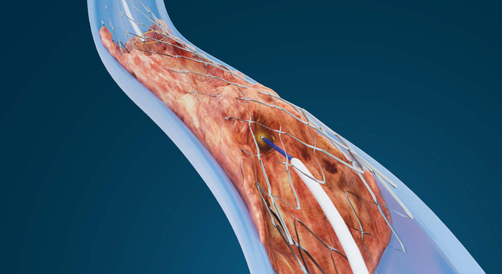 Baylis Medical announces first commercial use of PowerWire Pro