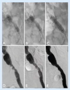 Changing the treatment mindset for calcified external iliac artery ...