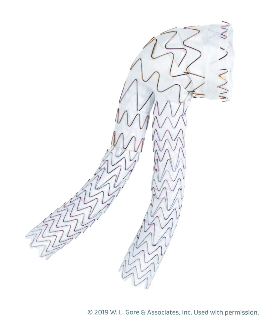 Gore announces first commercial implant of Excluder conformable AAA ...